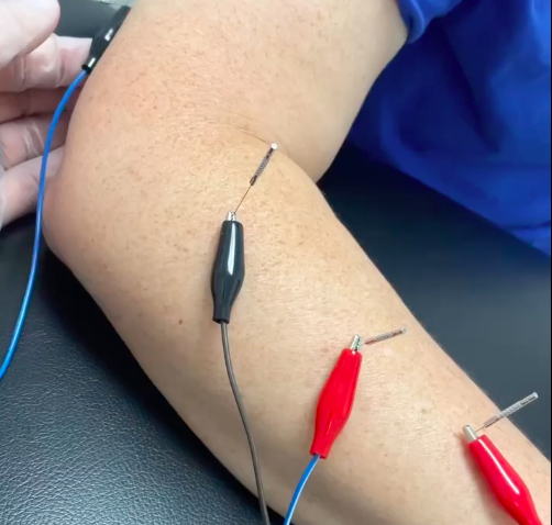 Accelerating Muscle Recovery with Dry Needling Techniques